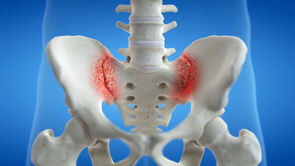 Sacroiliac (SI) Joint Fusion: Symptoms, Causes, Treatment